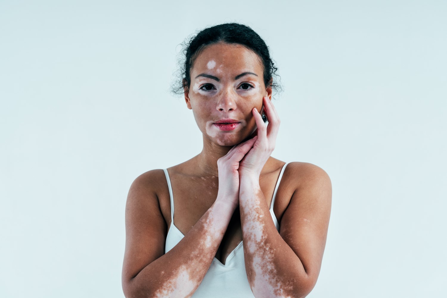 Vitiligo Treatment Options: A Comprehensive Guide - cosmocureclinic